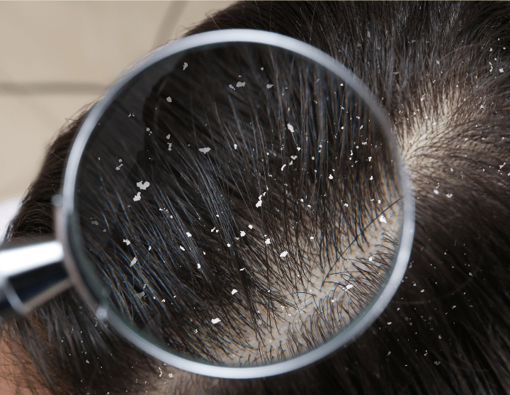 Dandruff: causes, remedies and tips that help - Iyurved